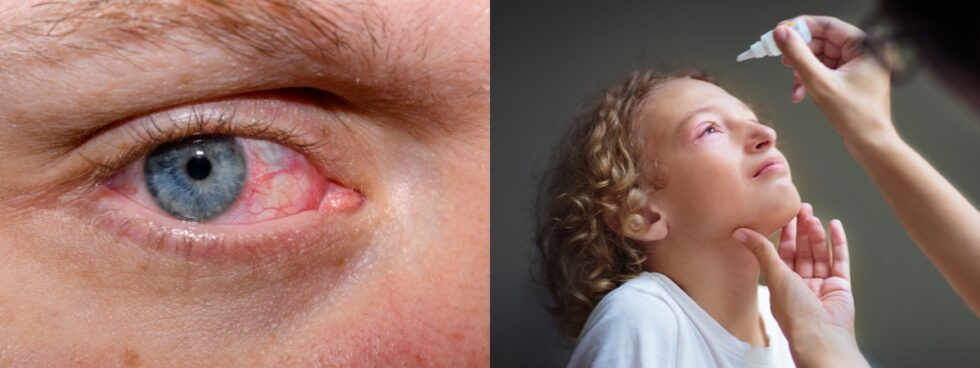 Pink Eye Treatment ER in Houston, TX | 24/7 Emergency Eye Care ...