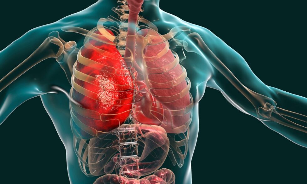 Bronchitis Symptoms, Recovery Time, and ER Visit | Montrose Emergency Room